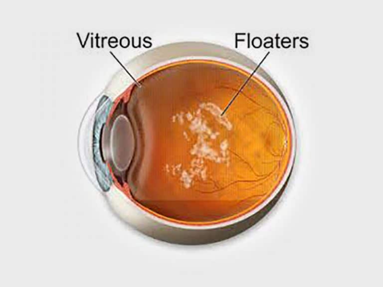 Diagnosis and Treatment of Medical Eye Conditions | Volunteer Eyecare