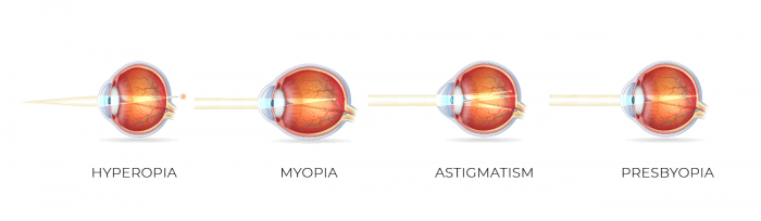 Common Vision Problems - Volunteer Eyecare